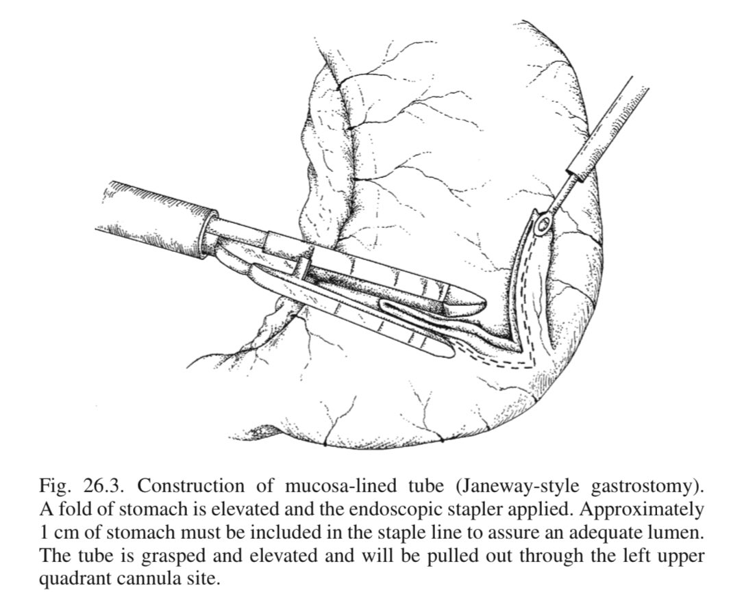 Janeway Gastrostomy Tube