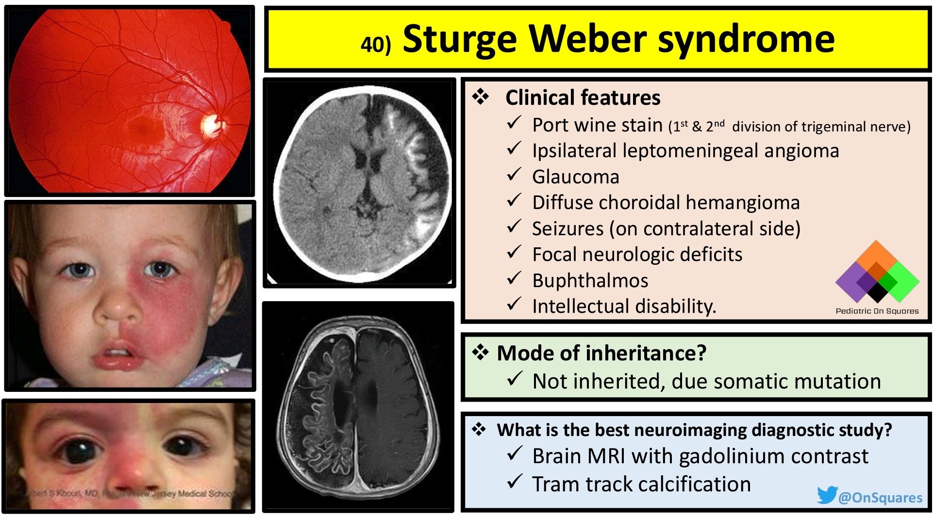 Leptomeningeal Angiomas