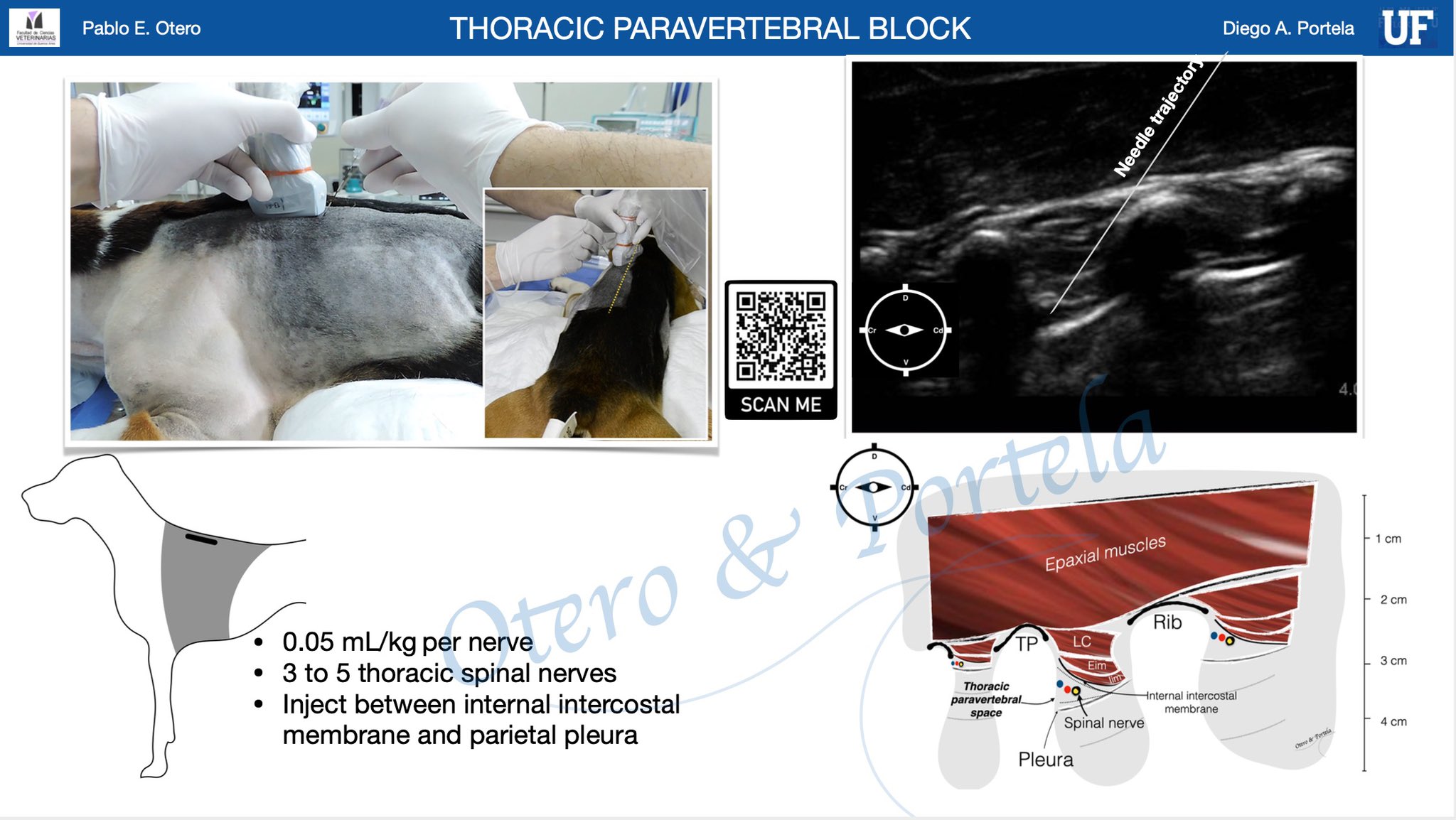Paravertebral Block Ultrasound