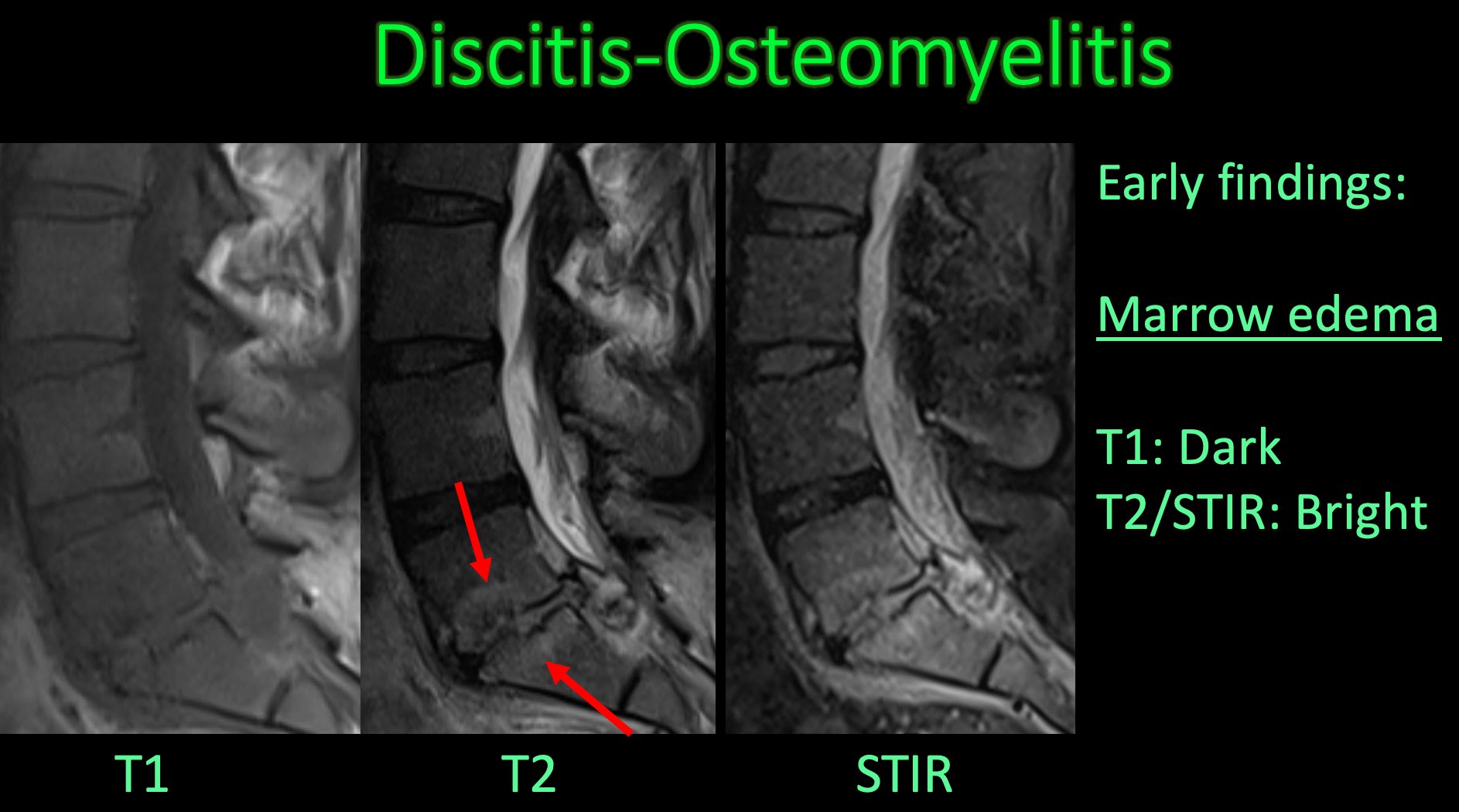 Osteomyelitis X Ray Spine