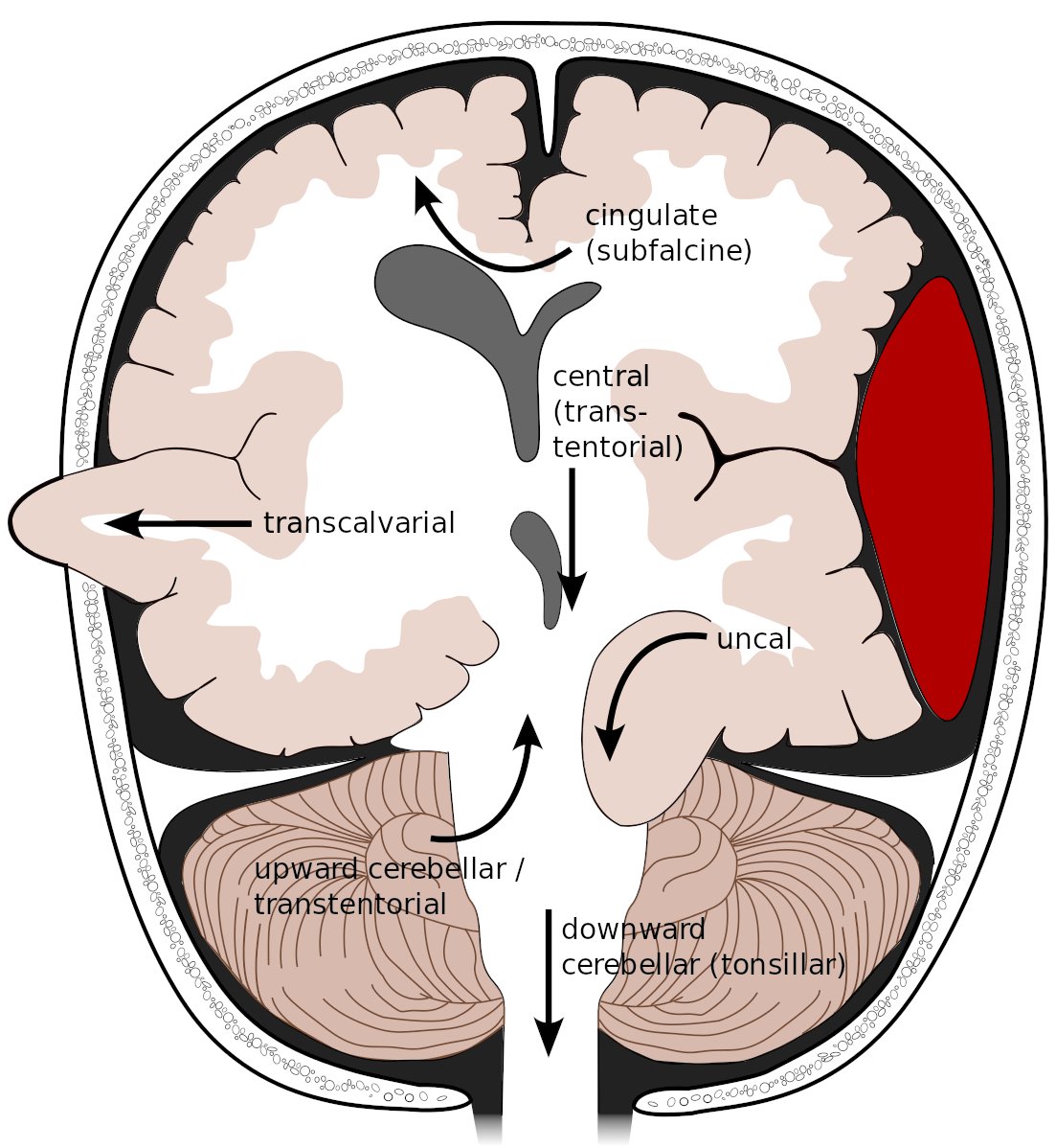 Tentorial Notch