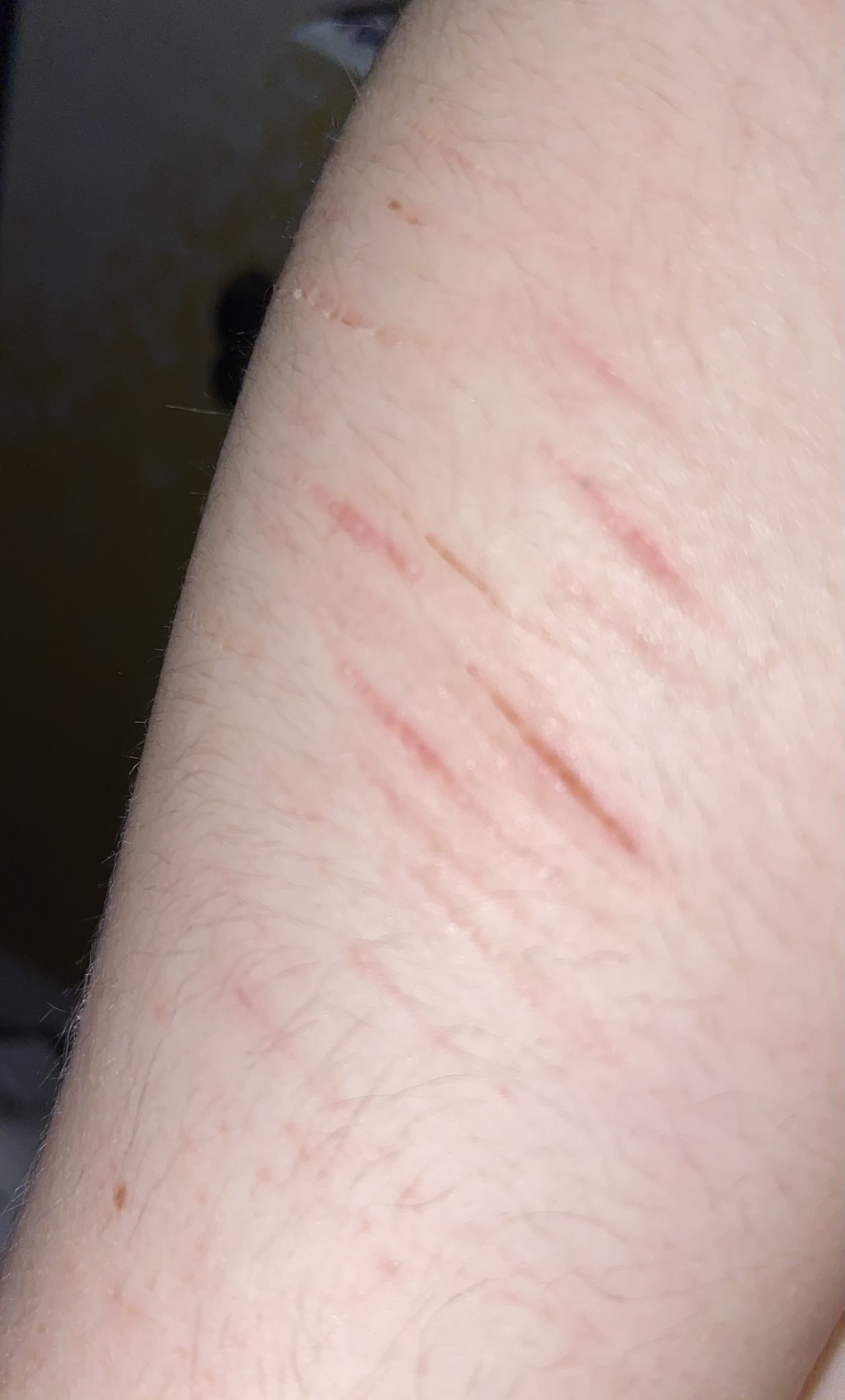 Wrist Scars