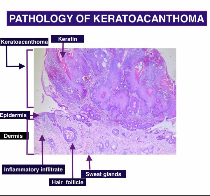 Keratoacanthoma Histology Multiple Self Healing Squamous Epithelioma