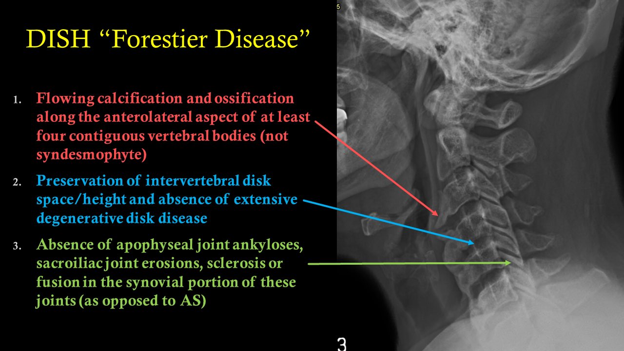 Diffuse Idiopathic Skeletal Hyperostosis Cervical Spine