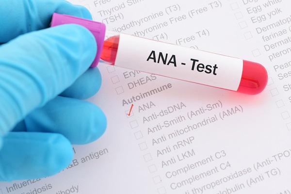 Anti Nuclear Antibody Positive Result