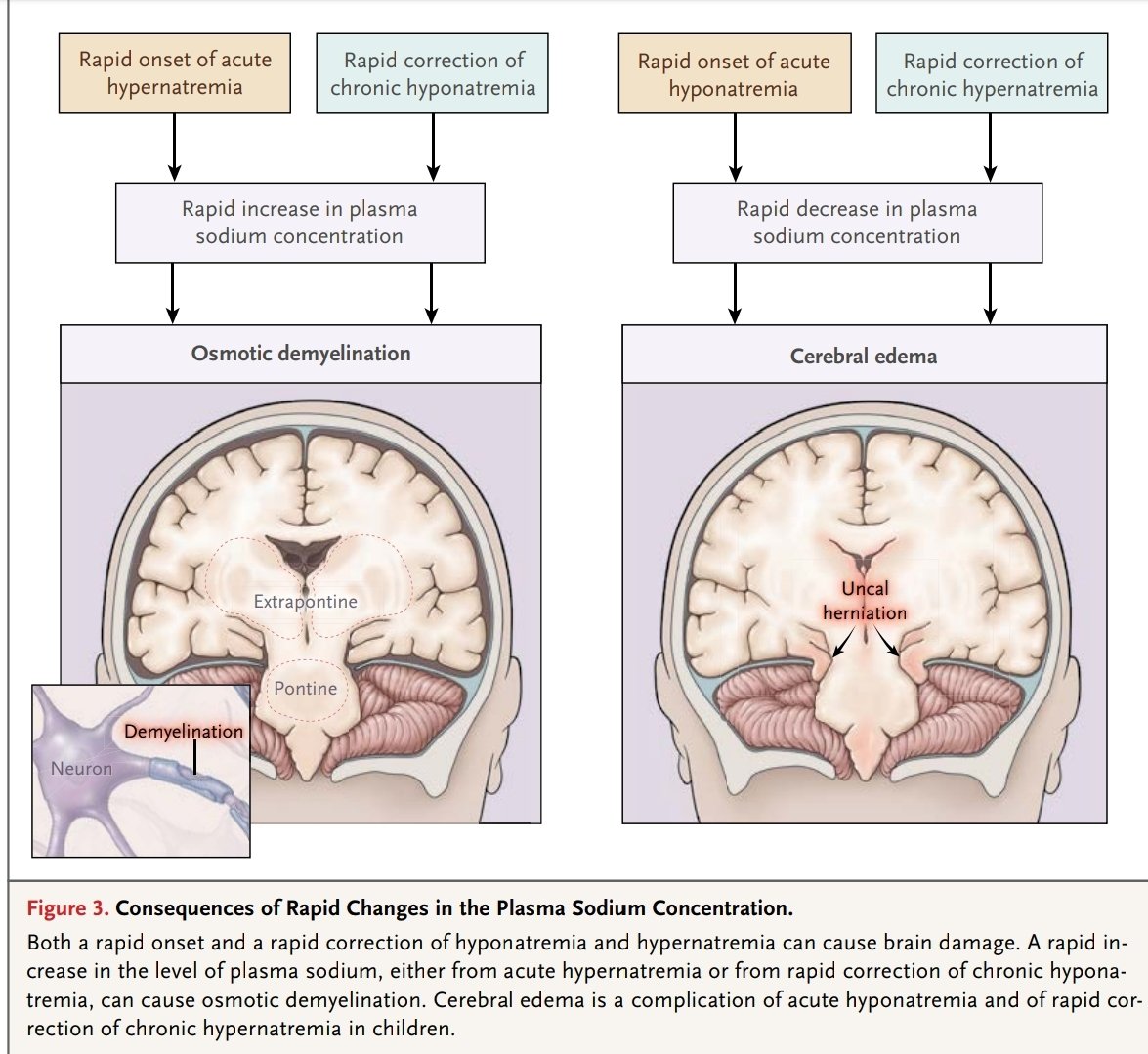 🌸Consequences of Rapid Change in Plasma Na Concentration ♨️Key mediator ...