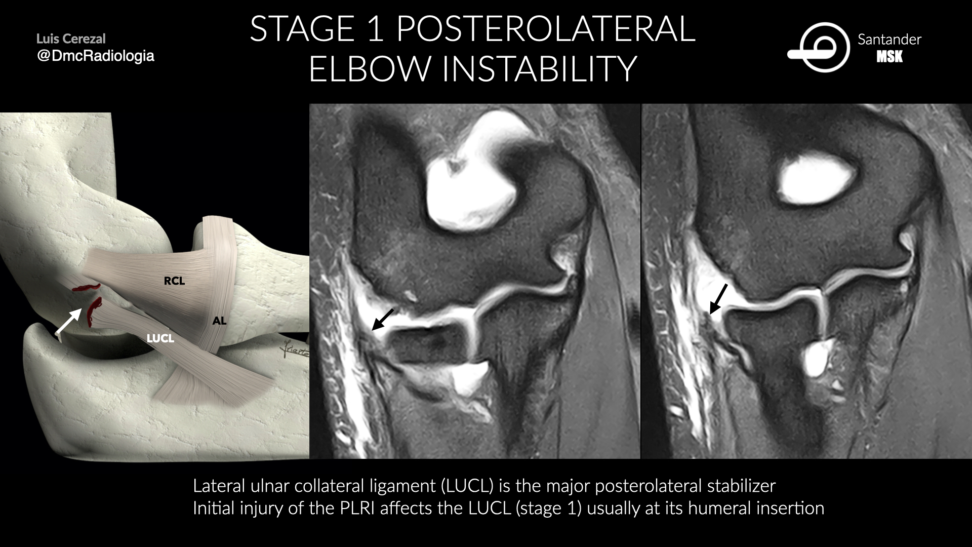 Medial Collateral Ligament Elbow Mri