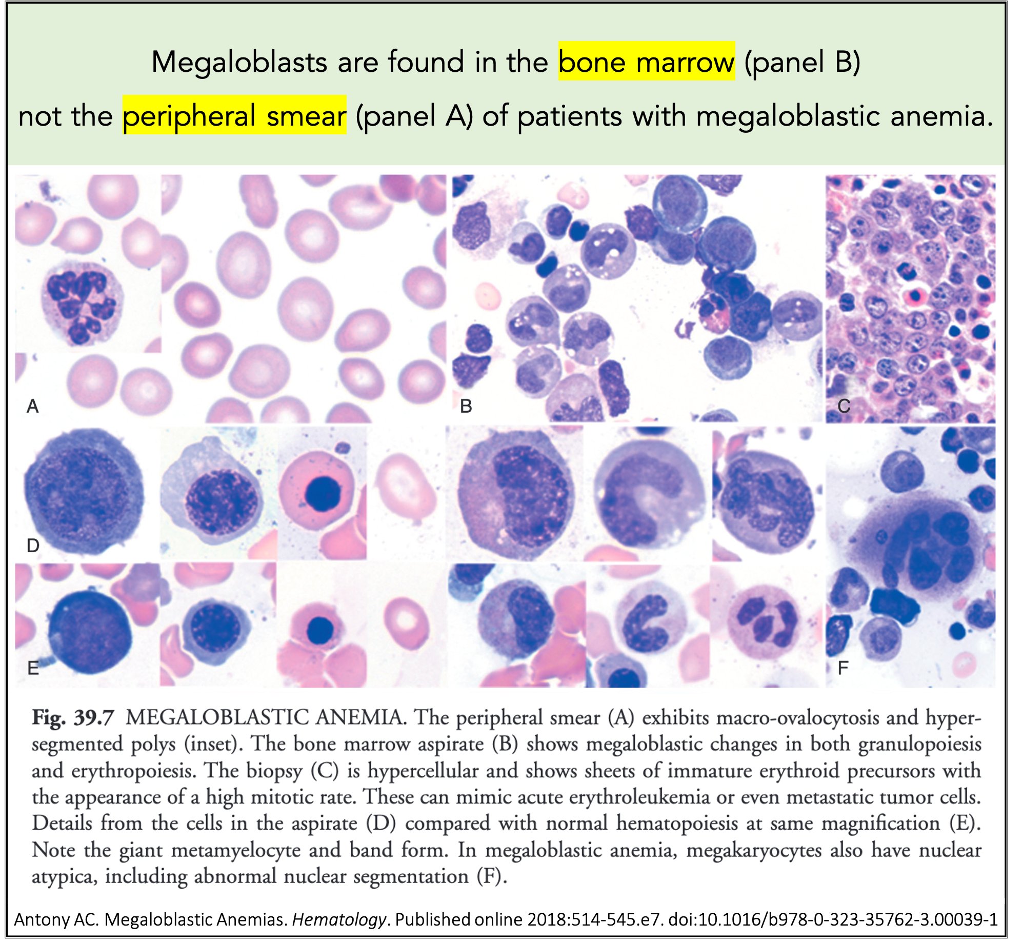 Megaloblastic Anemia Bone Marrow