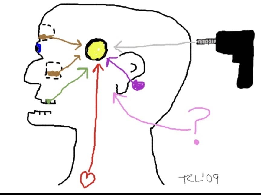 Images of Infectious Diseases 65M, MN w/ stroke symptoms 1 mo: root ...