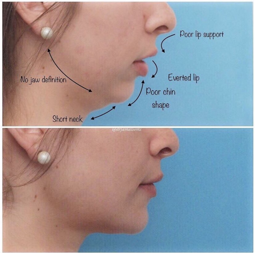 No Jawline Definition