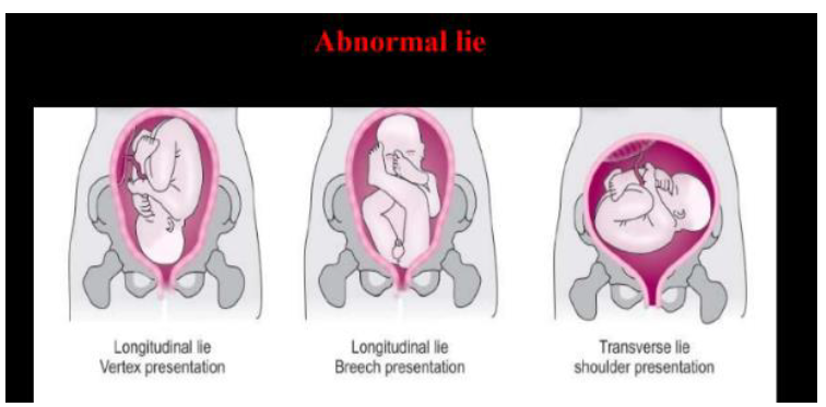 Oblique Lie Presentation