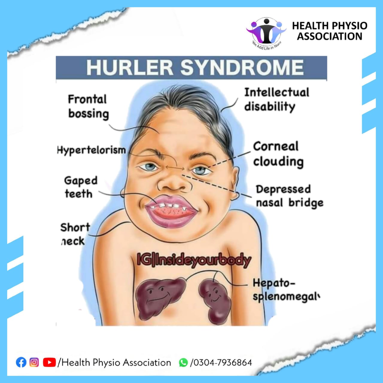 Hurler Syndrome By Mohammed Mater, 59% OFF