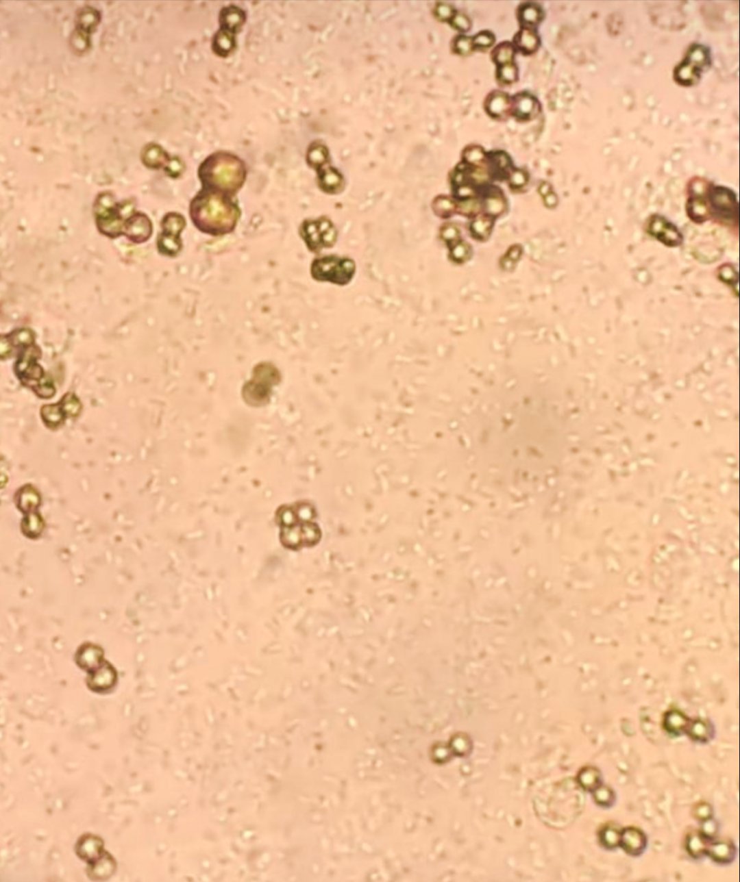 Calcium Carbonate Crystals In Human Urine