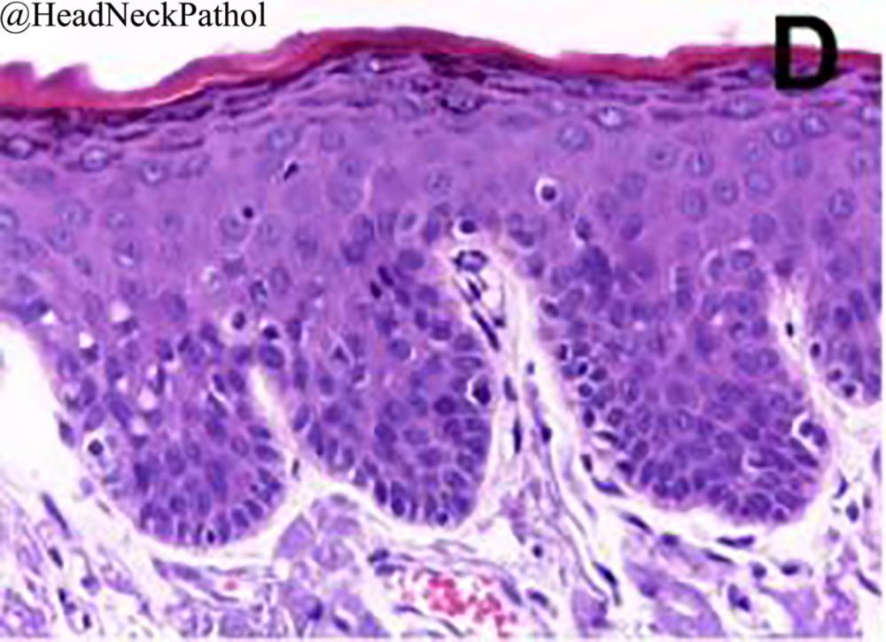 Actinic Cheilitis Histology
