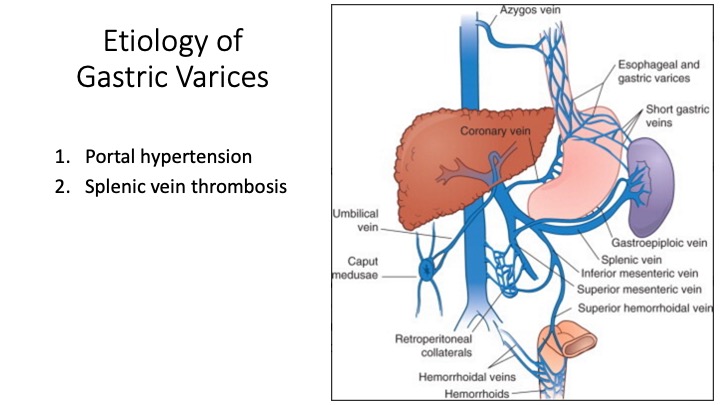 Splenic Vein Clot