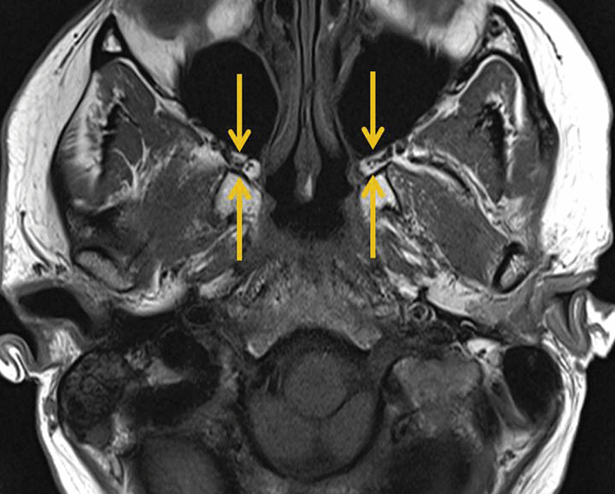 The most common nerves involved in perineural tumor spread in the head ...