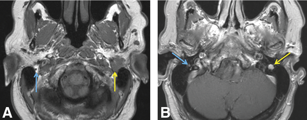 Stylomastoid Foramen Facial Nerve