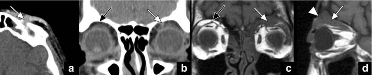 The most common nerves involved in perineural tumor spread in the head ...