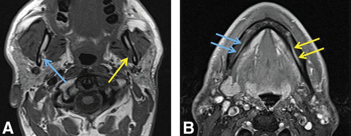 Retromolar Pad Radiograph