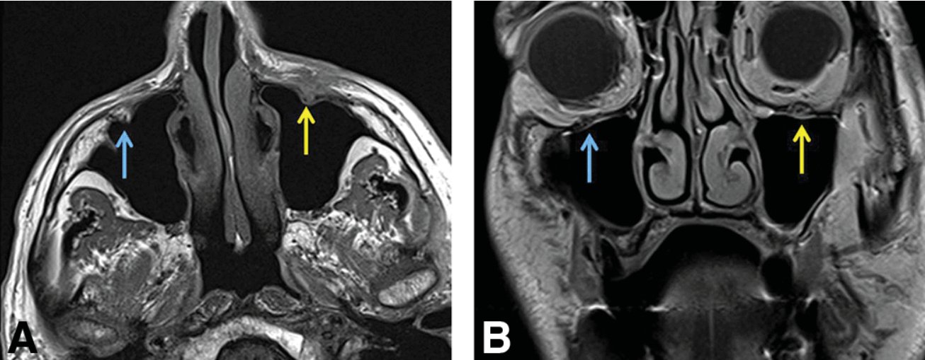 Infraorbital Canal