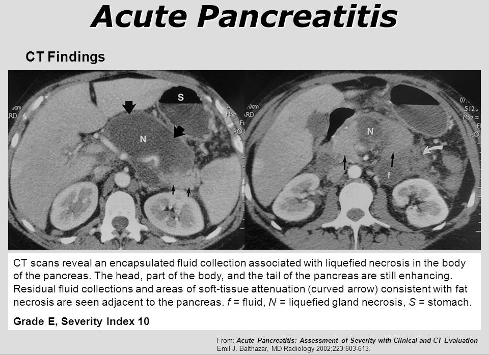 Peripancreatic Inflammation
