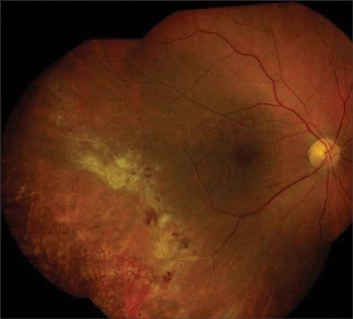 Cmv Retinitis