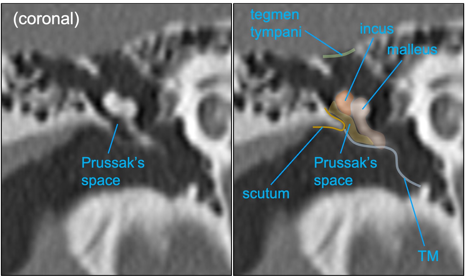 Scutum Temporal Bone