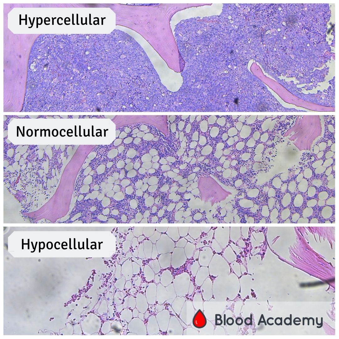 Normal Bone Marrow Cells