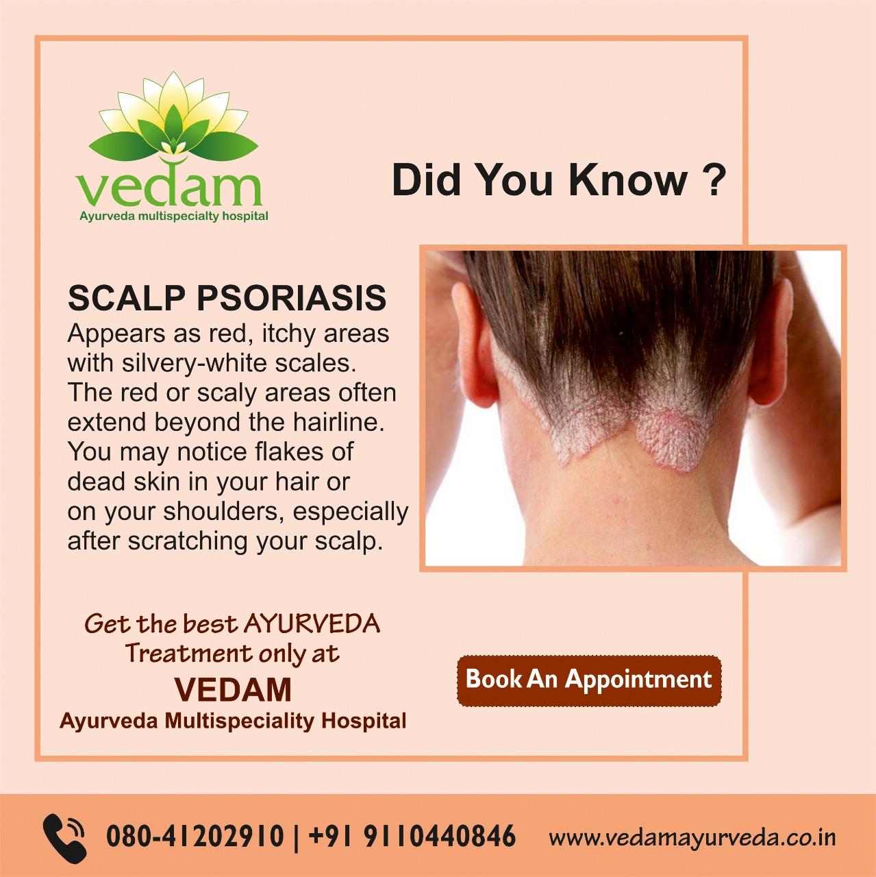 Psoriasis Scalp Flakes
