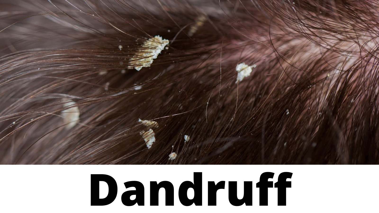 Severe Dandruff