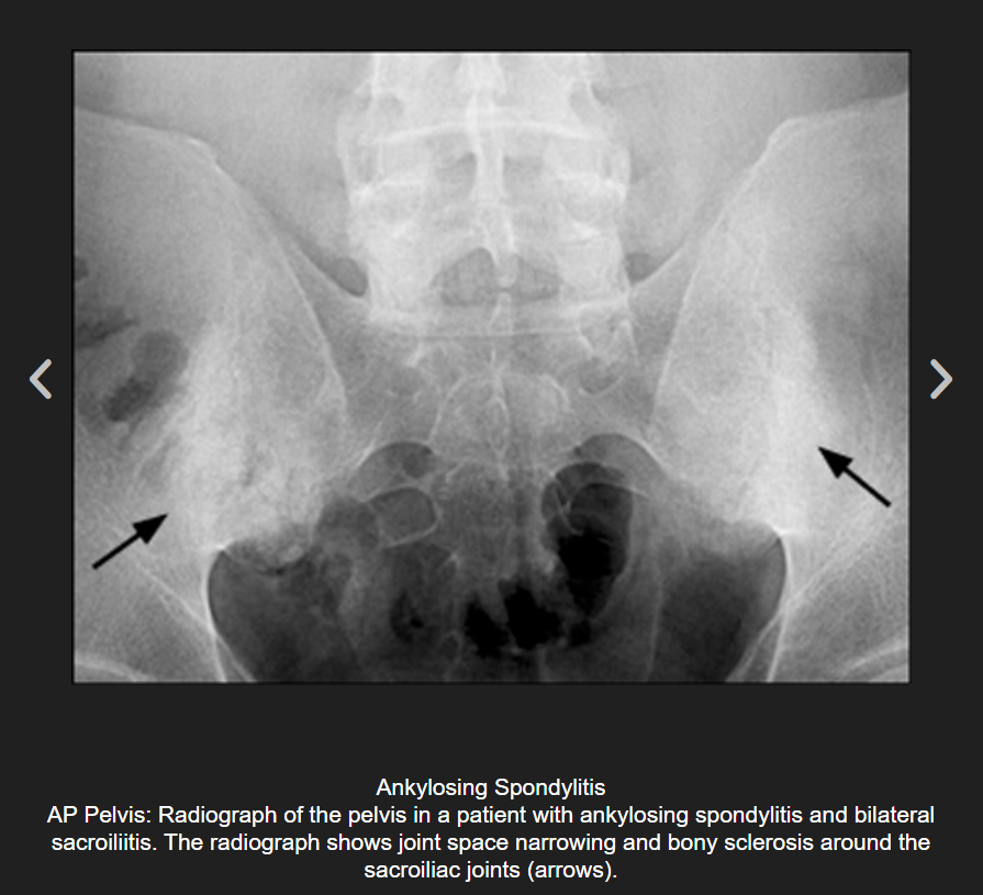 Sacroiliac Joint Erosion