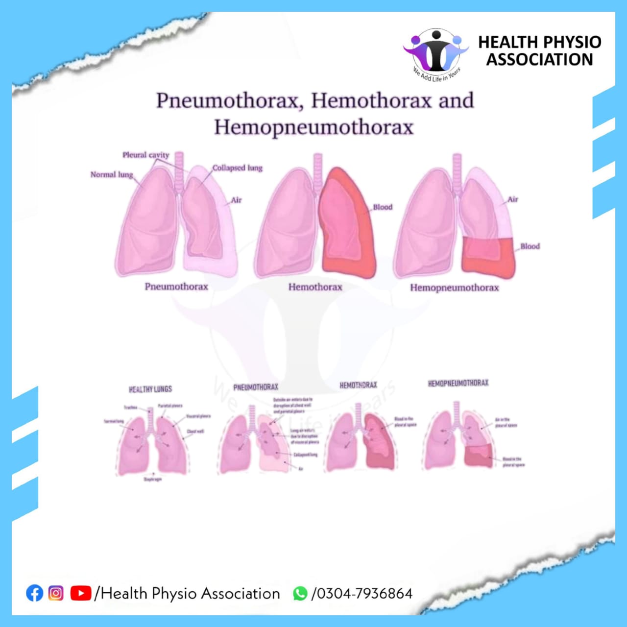 Picture Pneumothorax Hemothorax