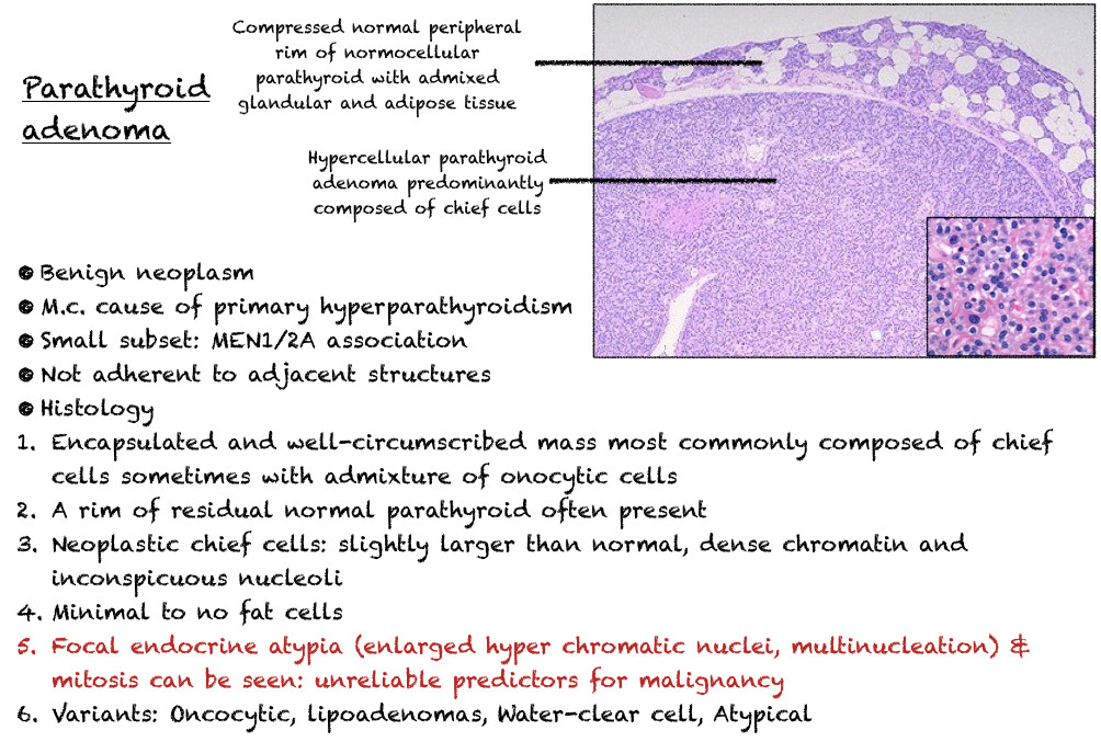 Parathyroid Adenoma Histology