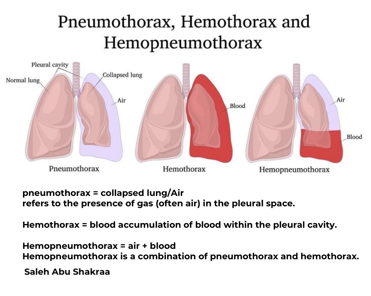 Hemopneumothorax