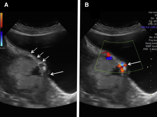 Placenta Percreta Ultrasound