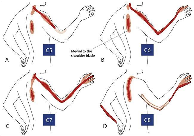 Herniated Cervical Disc