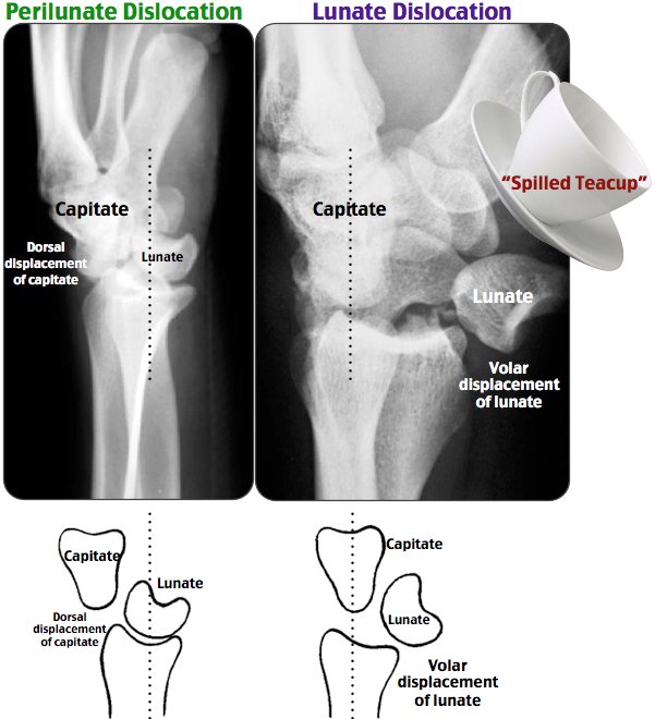 Perilunate And Lunate Dislocation Types