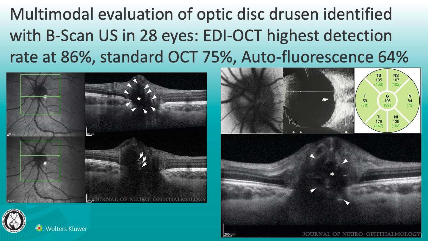 Optic Disc Drusen Oct