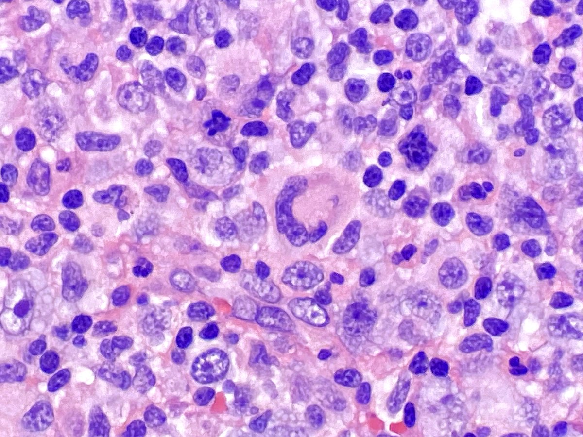 Anaplastic Large Cell Lymphoma Hallmark Cell