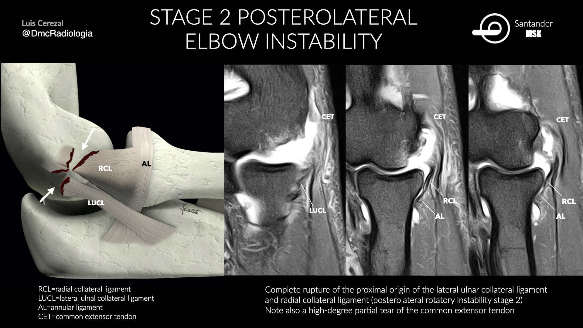 Radial Collateral Ligament Elbow