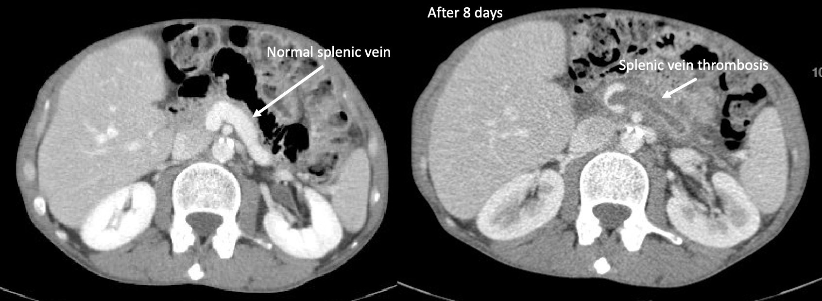 Splenic Vein Thrombosis