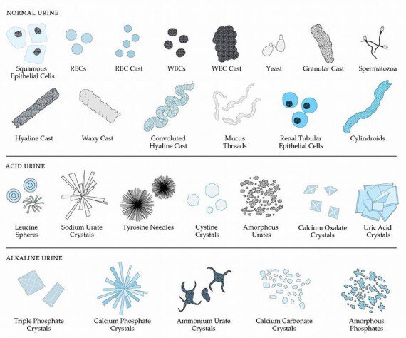 Calcium Carbonate Crystals In Urine
