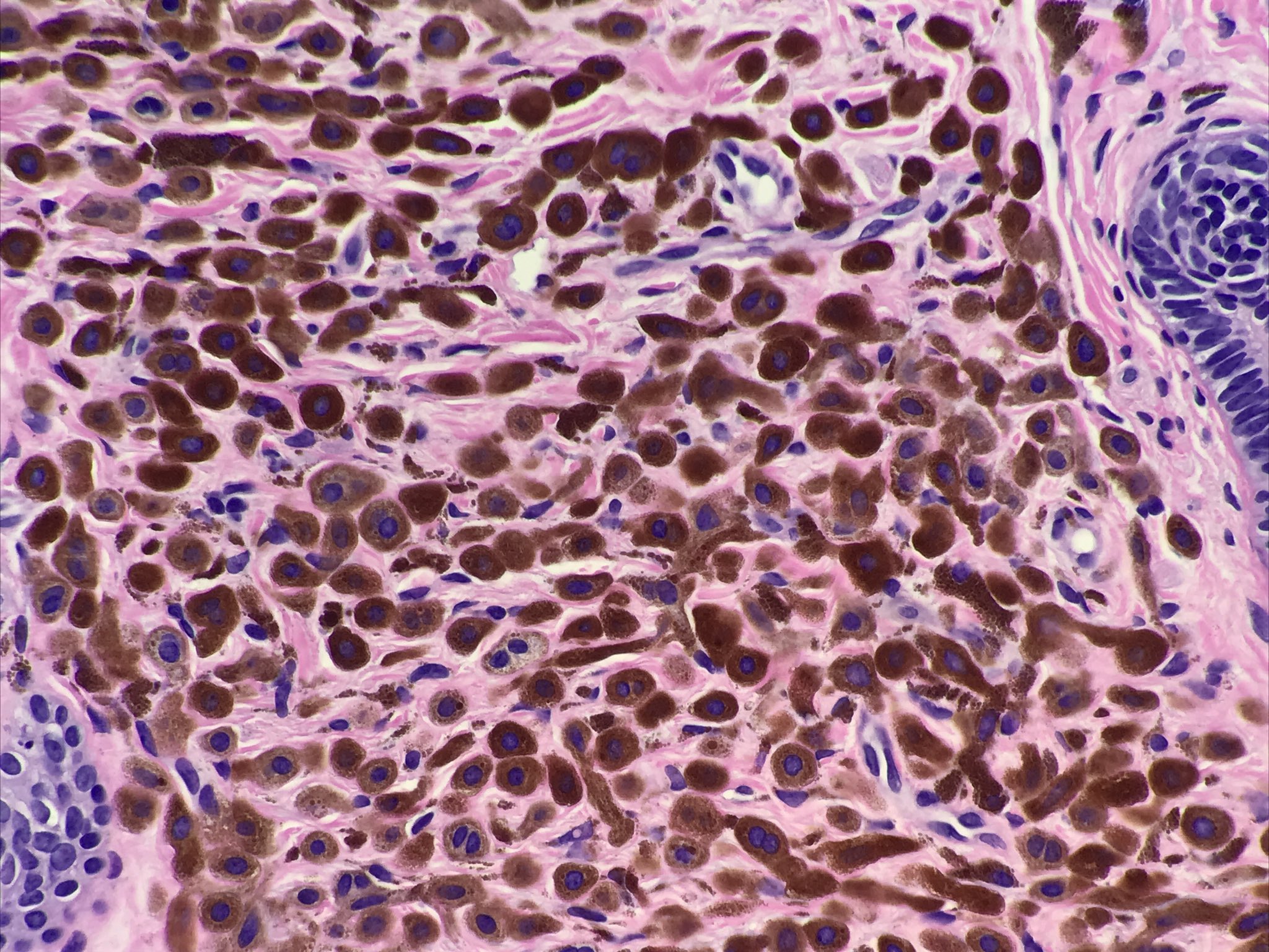 Blue Nevus Histology
