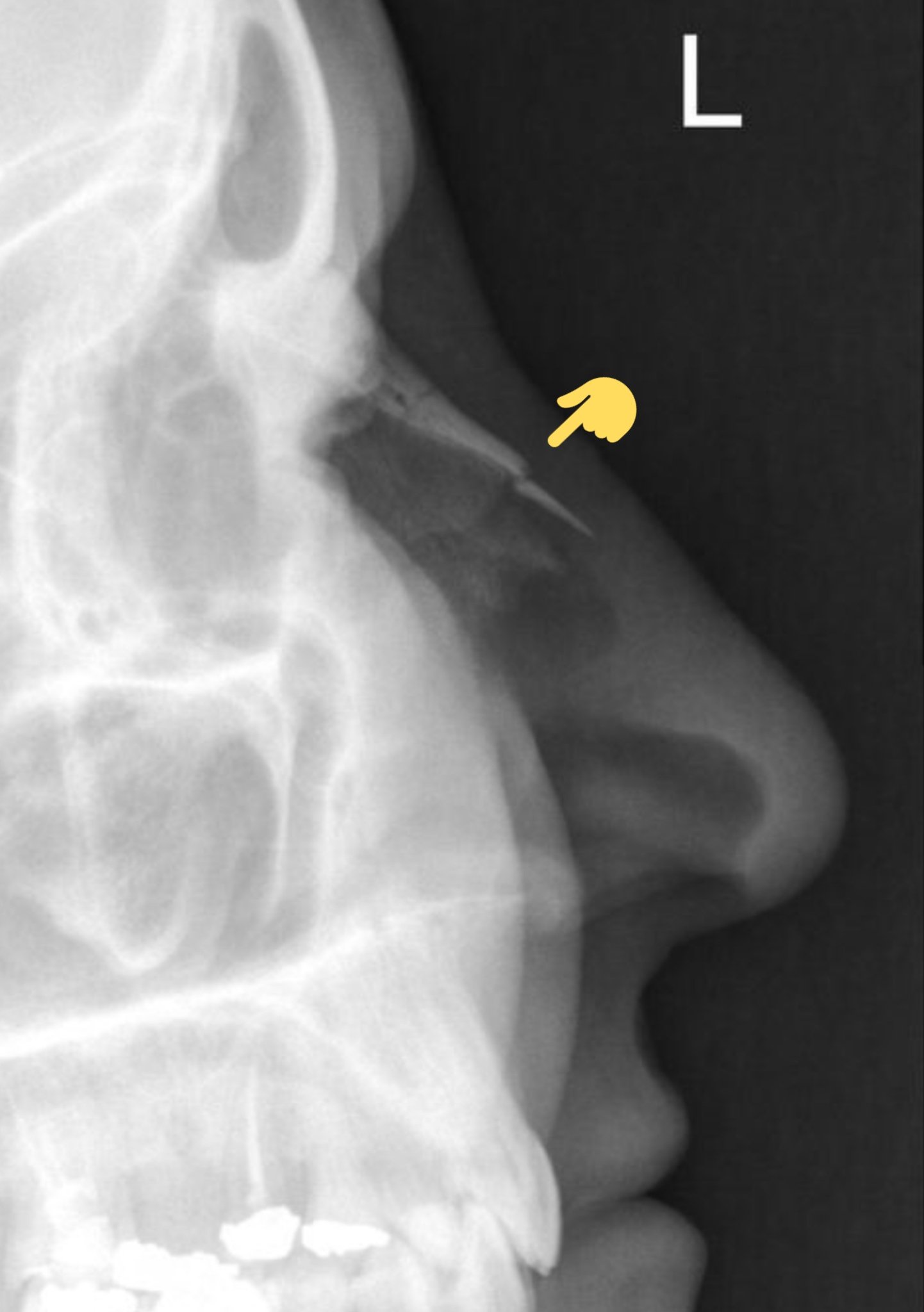Nasal Bone Fracture