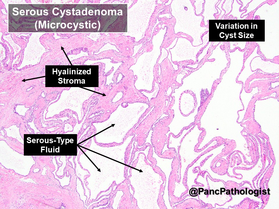 Serous Cystadenoma Histology