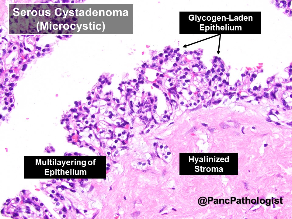 Serous Cystadenoma Histology