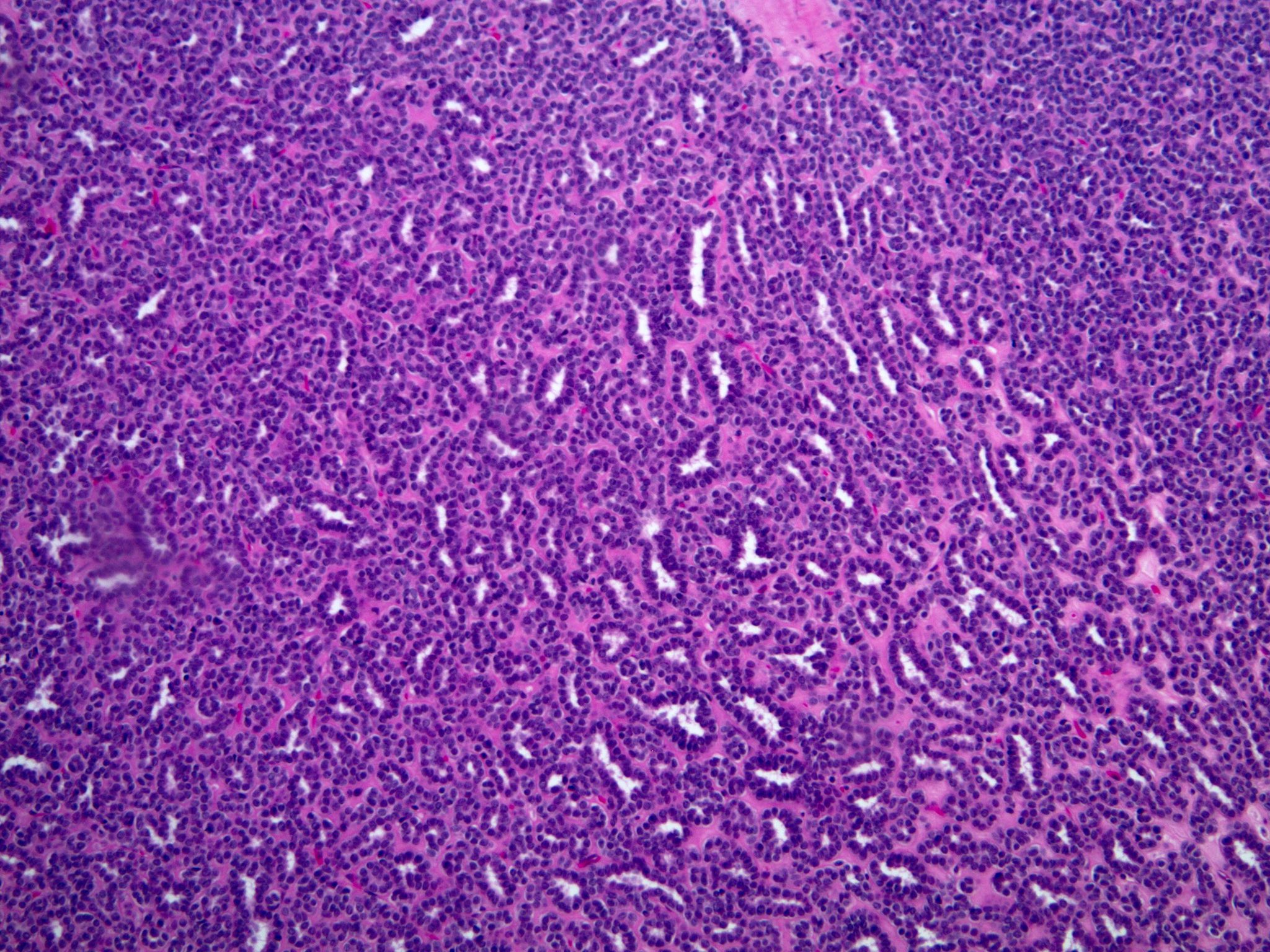 Metanephric Adenoma Pathology Outlines