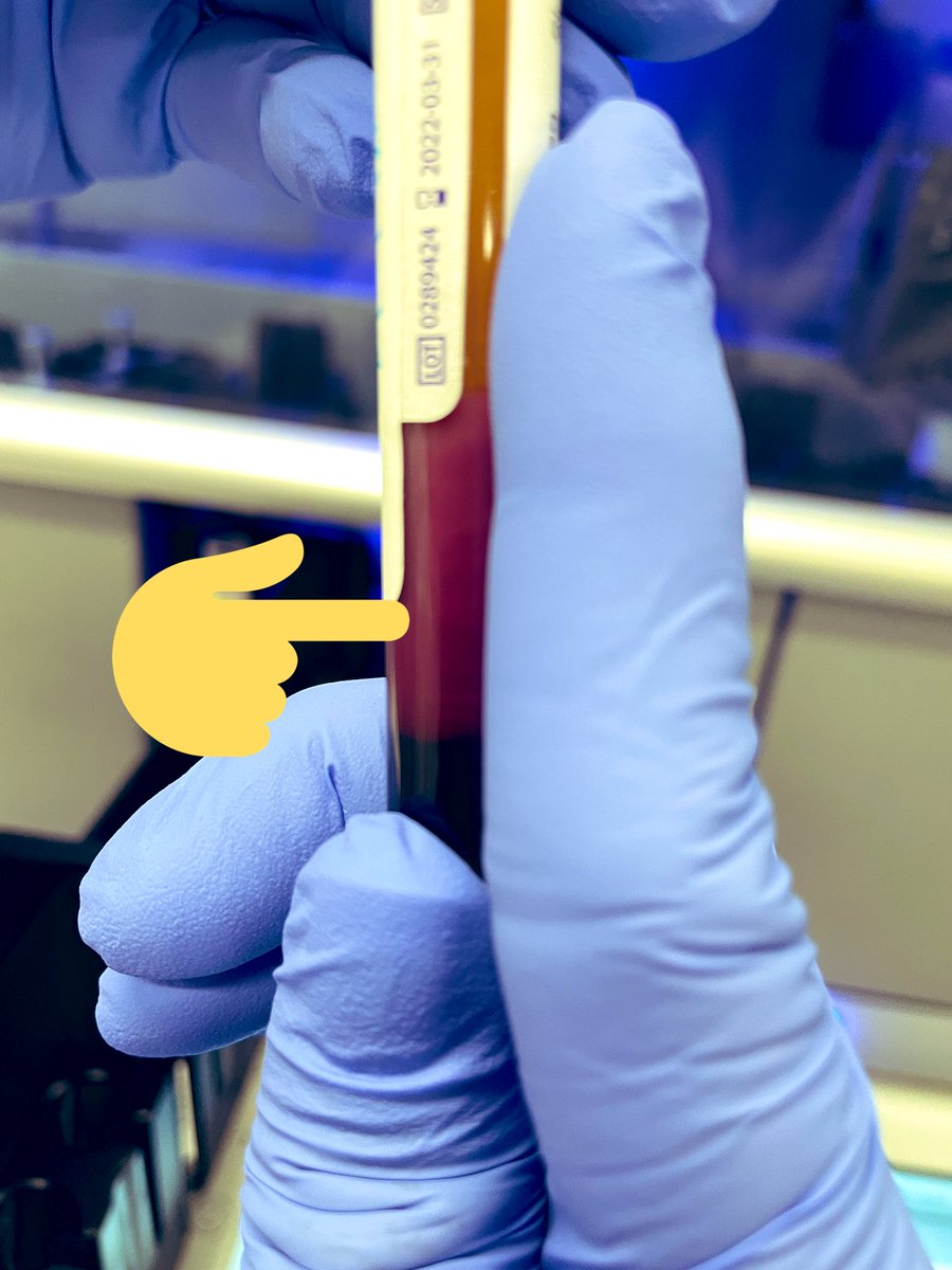 Transfusion-Associated Circulatory Overload (TACO) Difficult to ...