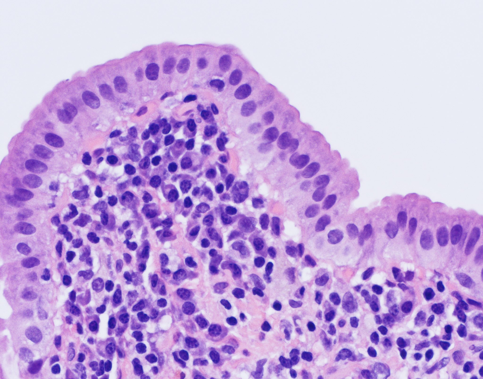Simple Columnar Epithelium Gallbladder