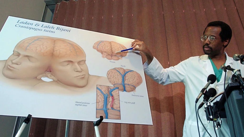 Ben Carson First Separated Conjoined Twins